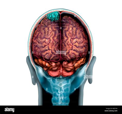Right Parietal Convexity