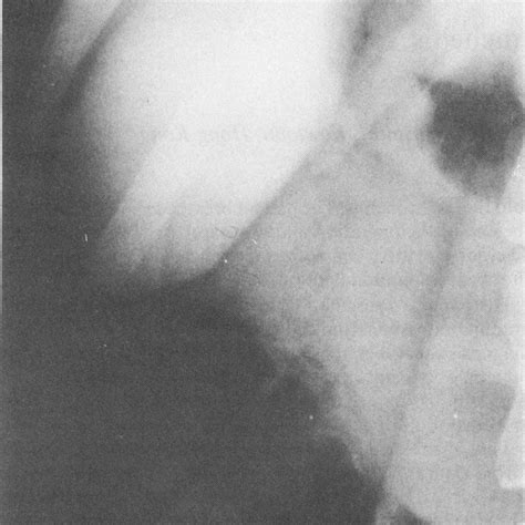 Cholecystogram One Year Afterfigure I Showing Complete Resolution Of Download Scientific