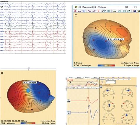 Balaram Et Al Describe Eeg Patterns In Electrical Status Epilepticus In Sleep Eses Based On