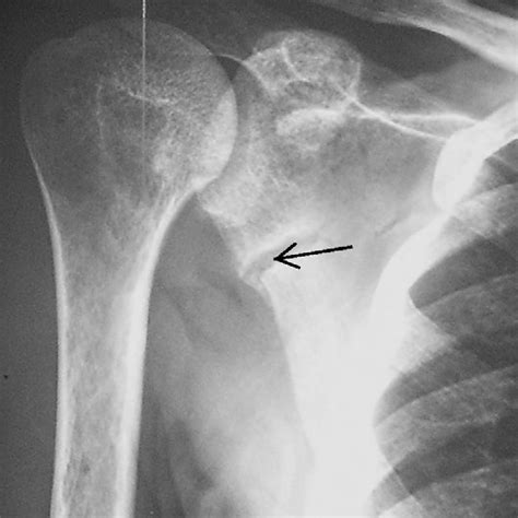 Advanced Osteomalacia With Protrusioacetabuli And Triradiate Pelvis