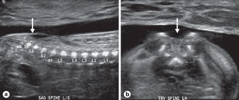 Spina Bifida Occulta Ultrasound