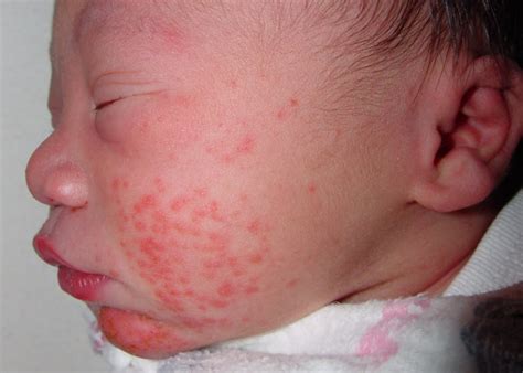 Acne Neonatorum Vs Erythema Toxicum