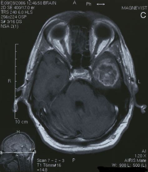 Imagenología De La Cabeza Y El Cerebro Concise Medical Knowledge