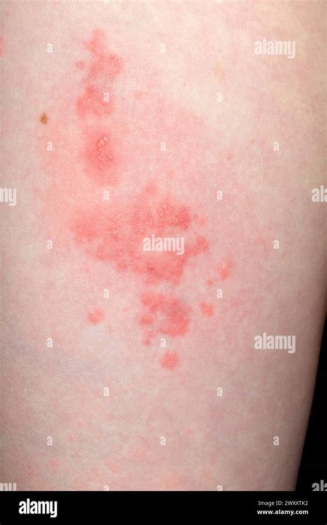 What Does Herpes Look Like On Inner Thigh