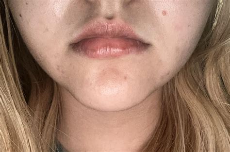Allergic Reaction To All Lip Balms Rdermatology