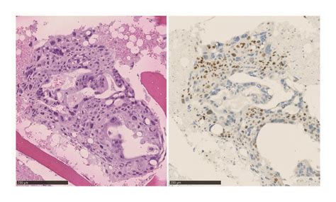 Left He Stained Section Of Choriocarcinoma Metastasis In L2 Right