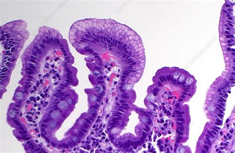 Peptic Duodenitis Light Micrograph Stock Image C057 1437 Science Photo Library