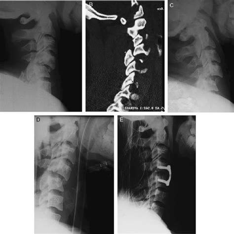 A And B Unilateral Facet Fracture Dislocation At The C4 C5 Level In A