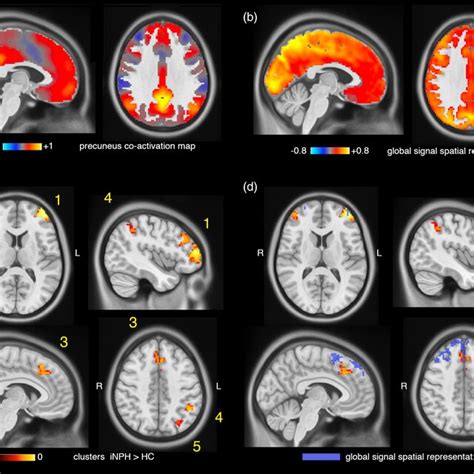 Resting‐state Network Connectivity In Inph Patients And Healthy Download Scientific Diagram