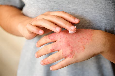 Eczema Expert Advice And Soothing Solutions For Relief Shafa Medical Clinic