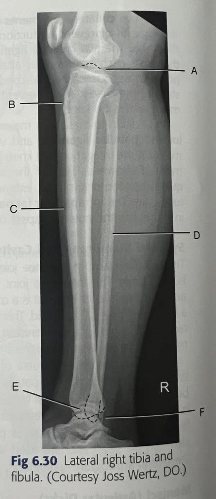 Lateral Right Tibia And Fibula Diagram Quizlet