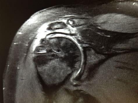 Postoperative Mri Arthrogram After A Rotator Cuff Bridging Procedure Download Scientific