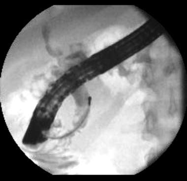 A B ERCP Done Before The Endoscopical Desobstruction With Calculi In Download Scientific