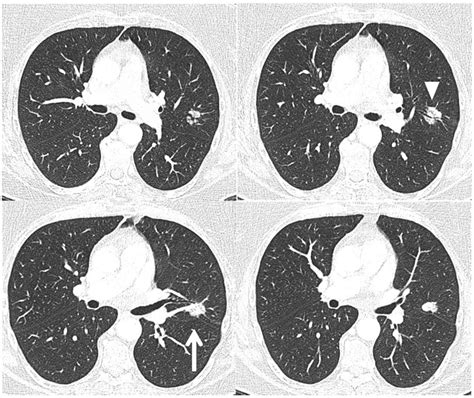 Chest Ct Shows A Well Defined Part Solid Nodule In The Superior