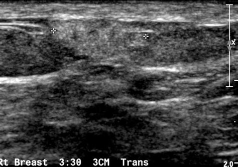 Echogenic Breast Masses At Us To Biopsy Or Not To Biopsy Radiographics