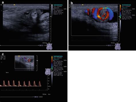 Doppler Sonography Of The Scrotum Radiology Key