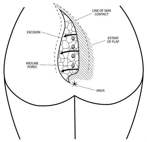 Cirugía Pilonidal De Bascom Innova Cirugía