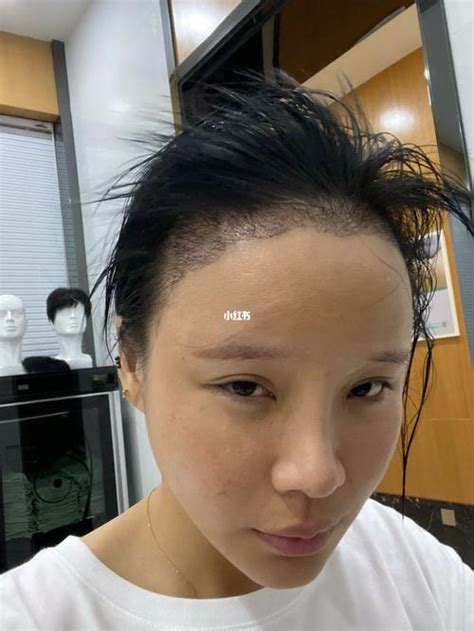发际线移植效果图 配图网