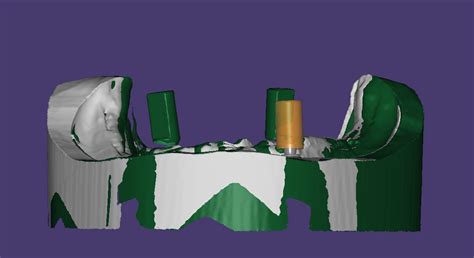 Fixing Bad Surface Orientation In Scan Data Exocad