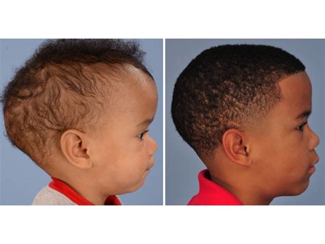 Sagittal Synostosis Scaphocephaly — Dallas Pediatric Plastic Surgeon Craniofacial Surgeon