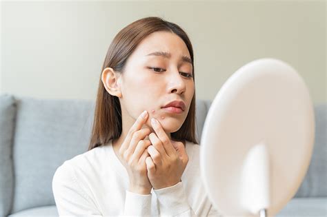 10 Natural Ways To Treat Acne Ex Tremes