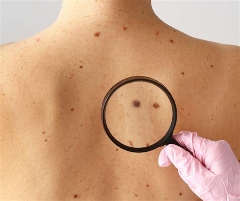 Mole Scanning Early Detection Improves Outcomes And Saves Lives