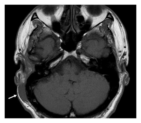 Mpnst Of The Right Postauricular Region A B Axial T1 And