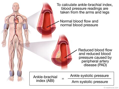 Ankle Brachial Index