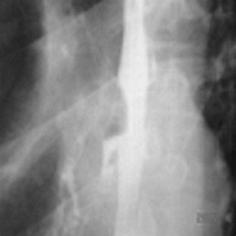 A Preoperative Esophagogram Depicting The Fistulous Communication To