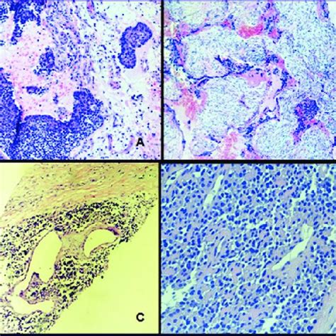 A Nests Of Atypical Cells With Hyperchromatic Nucleus And Scanty Download Scientific Diagram