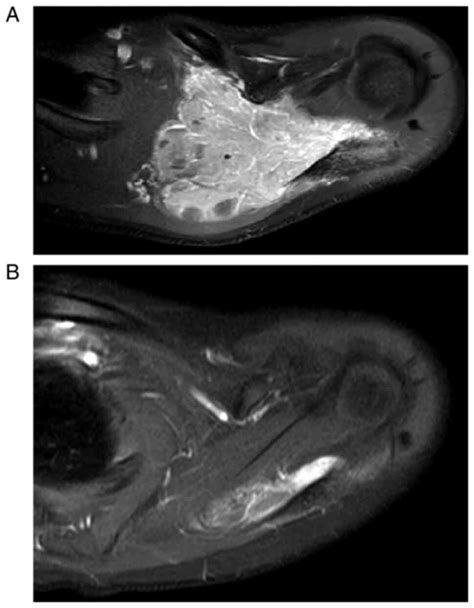 Ewing Sarcoma Mri