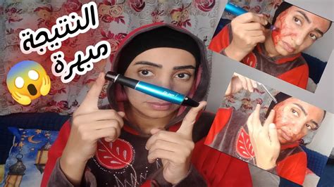 عملت جلسة ديرما بن لبشرتي⁉️ لعلاج ندبات حب الشباب وتصبغات الجلد ونضارة