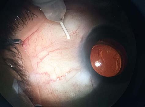 Injection Of Ta In The Suprachoroidal Space Using A Custom Made Syringe Download Scientific