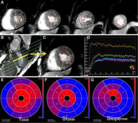 A Axial First Past Perfusion Images B Two Chamber Cine Image C Download Scientific Diagram