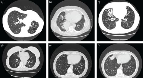 Biomarkers In Bronchiectasis Pmc