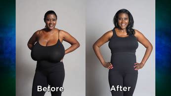 Biggest Breast Reduction In America Performed By Houston Surgeon Ahb