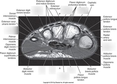 Axial T1 Wrist Metacarpal Diagram Quizlet