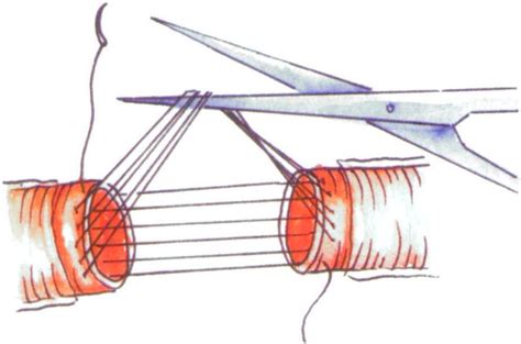 微血管吻合术 口腔颌面外科手术