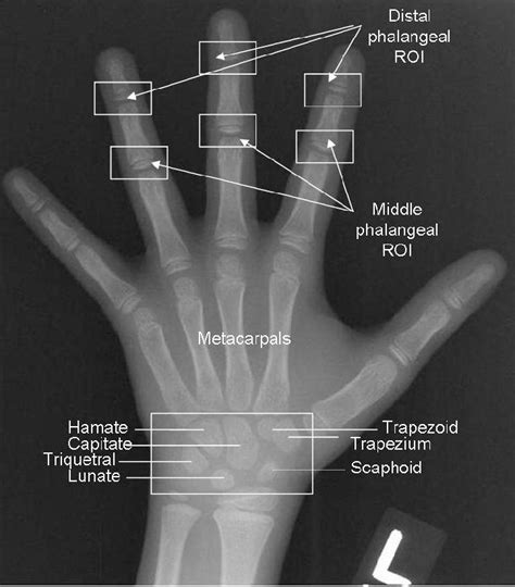 how to calculate bone age radiology at keith herrera blog
