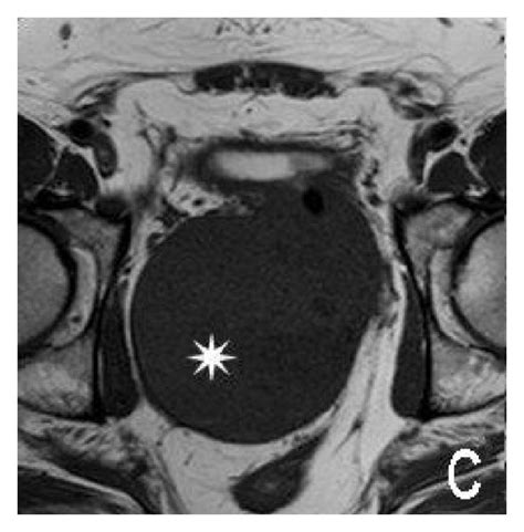 Mri Axial A And Sagittal B T2 Weighted Images Axial Precontrast