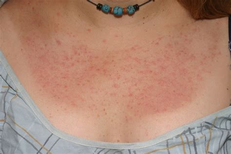 Polymorphous Light Eruption Symptoms Causes Risk Factors Diagnosis And Treatment Natural