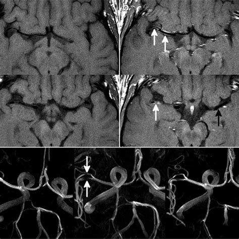 Central Nervous System Vasculitis Reprinted With Permission From Download Scientific Diagram