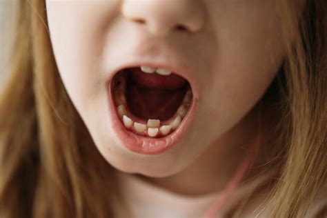 Why Are My Teeth Rotting And Breaking Off Causes And Treatments