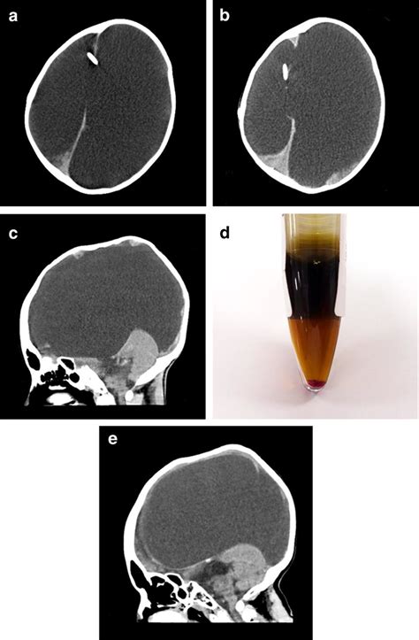 Case 1 A Ct Demonstrating Hydranencephaly B C Ct Demonstrating