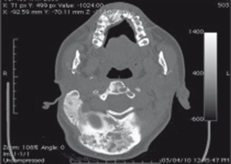 Cross Sectional View Of CT Scan Showing Growth In The Intercorticol Download Scientific Diagram