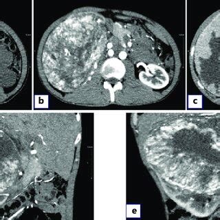 Preoperative CT And Intraoperative Imaging Examination A Plain Scan Download Scientific