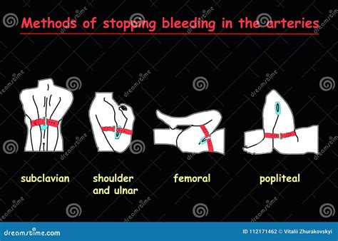 Arterial Bleeding