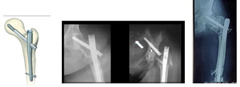 Headless Single Cervical Screw Penetrating In Through Nail Download Scientific Diagram