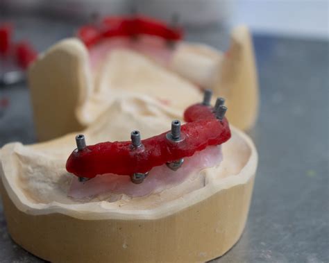 An Implant Verification Jig Is A Hallmark Dental Lab