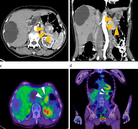 Figure1dynamic Computed Tomography Ct Scan Of The Abdomen A Axial Download Scientific